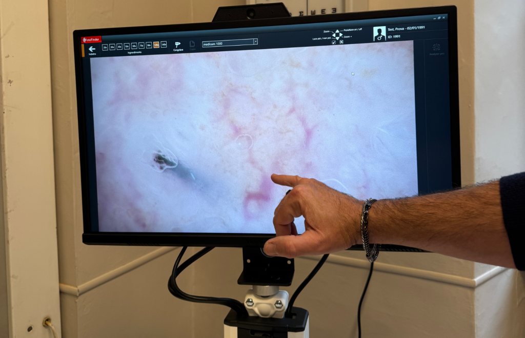 Esame dermatologico di videodermatoscopia per mappatura dei nei